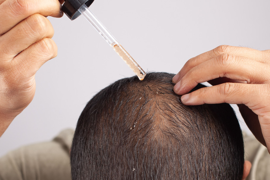 Minoxidil: o que é, para que serve e como utilizar? - Lívia Viccari ...