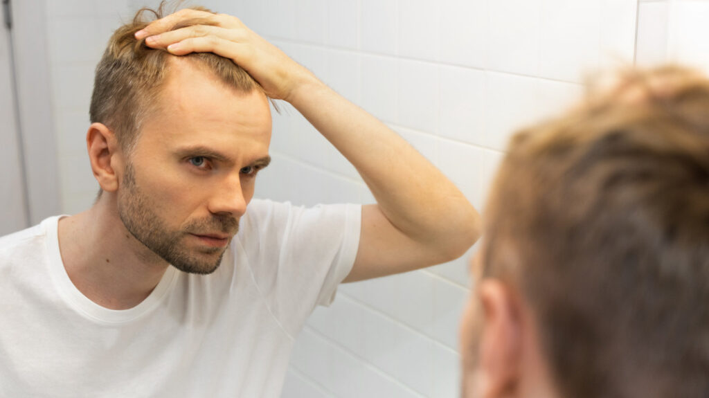 Calvície tem cura? Mitos e verdades sobre a Alopecia Androgenética ...