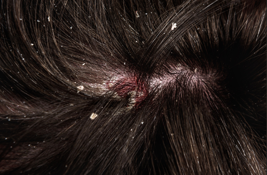 Tipos de caspa: como diferenciar da dermatite seborreica - Lívia ...